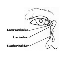 Watery Eyes - City Eye Specialists