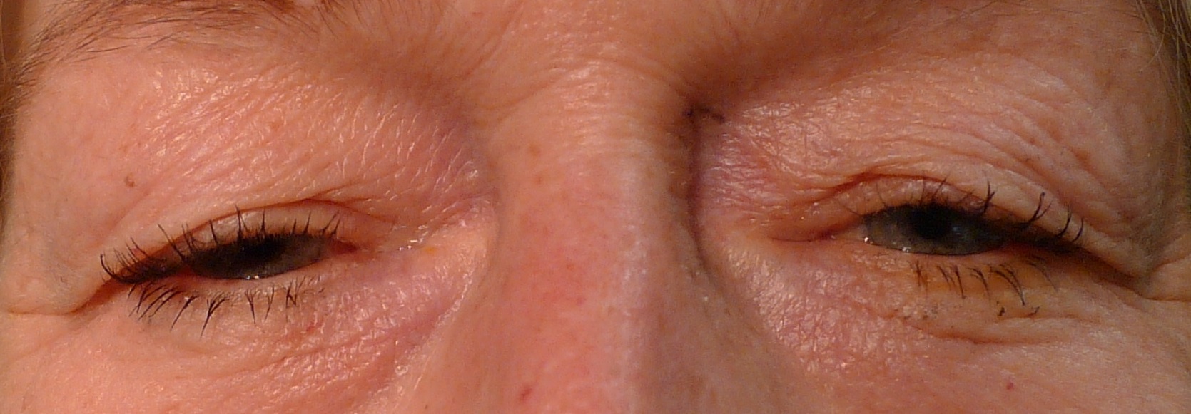 Eyelid Surgery: Blepharoplasty / Blepharoptosis - City Eye Specialists