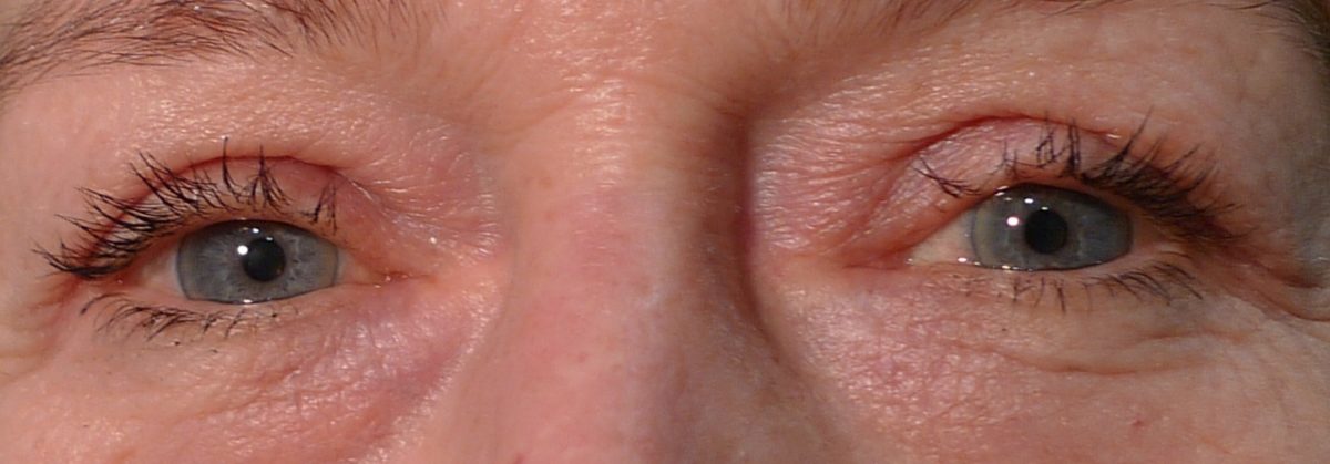 Eyelid Surgery: Blepharoplasty / Blepharoptosis - City Eye Specialists