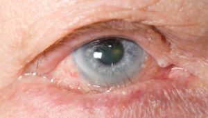 Trichiasis (misdirected eyelashes) - City Eye Specialists